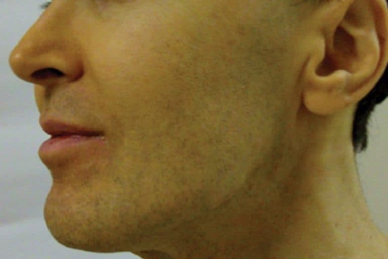 Yellow Spots on Skin: Causes and Treatments